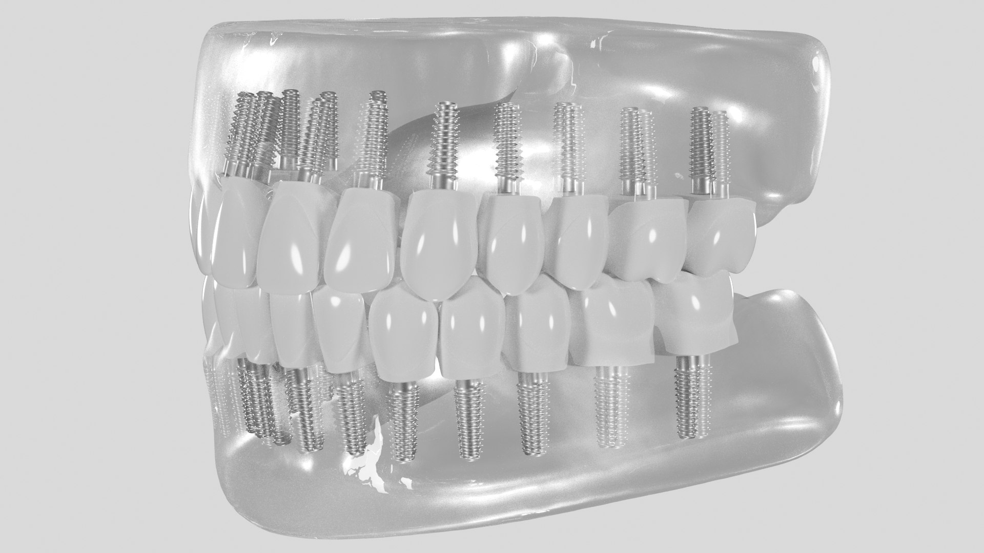 3D Dental Implant Model - TurboSquid 1722881