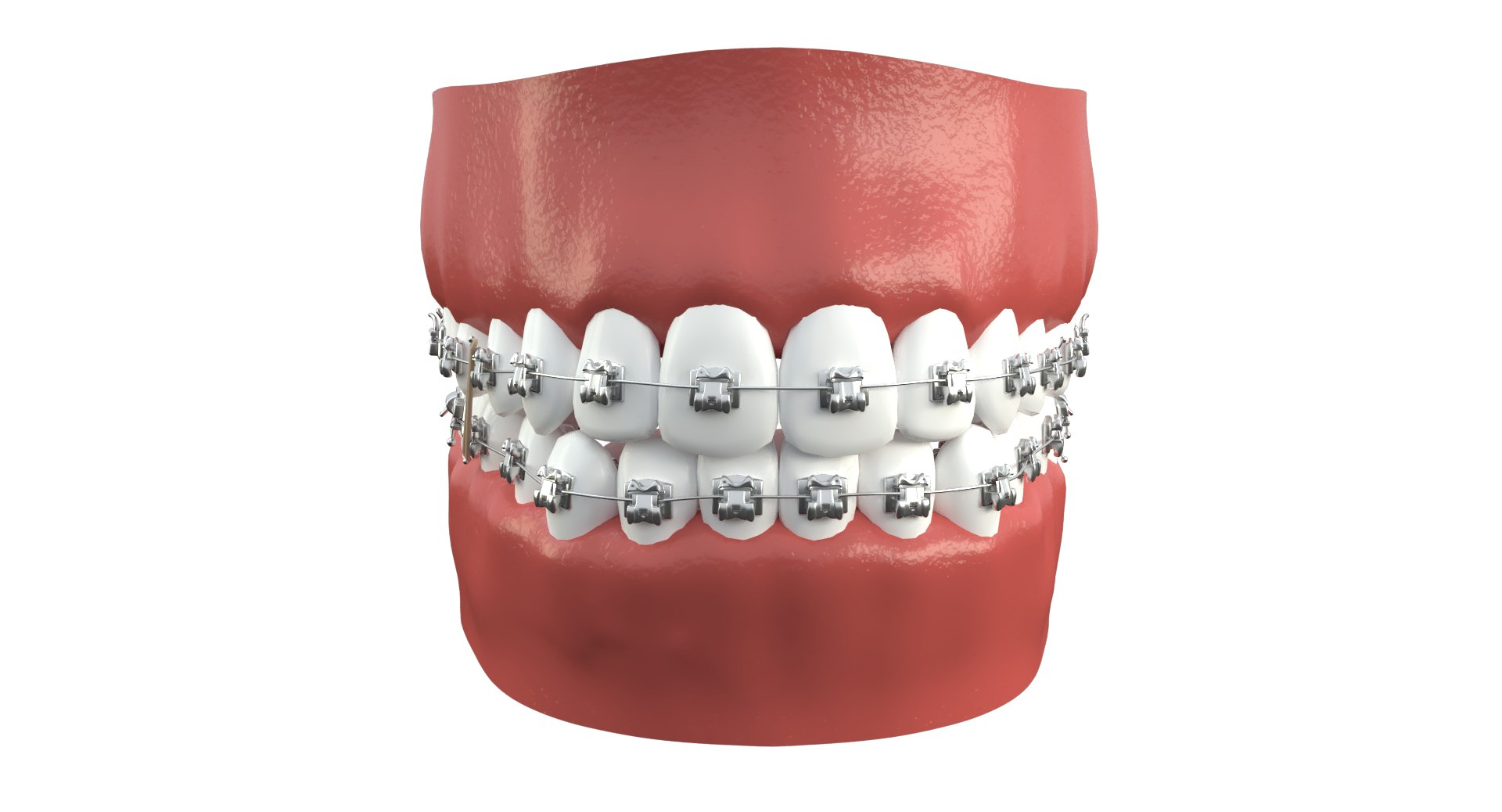 3D Model Teeth Braces - TurboSquid 1522317