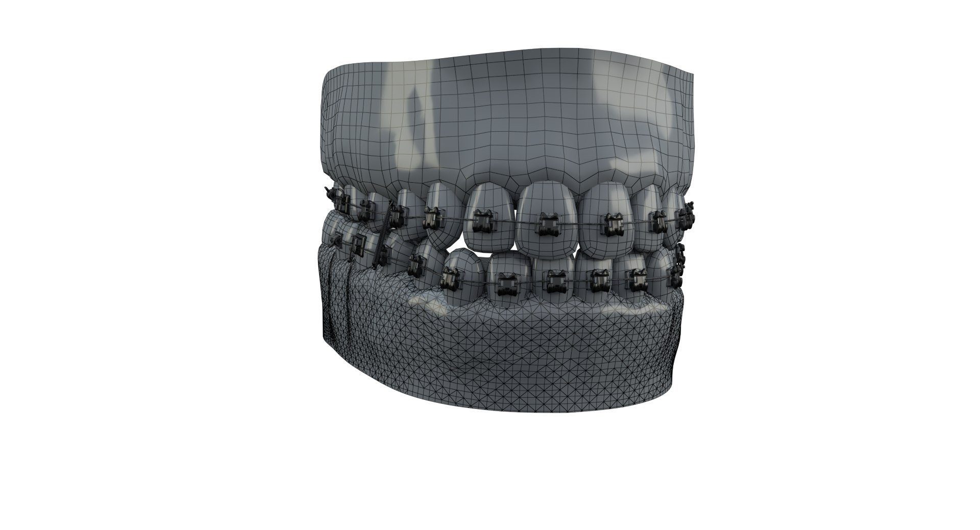3D Model Teeth Braces - TurboSquid 1522317