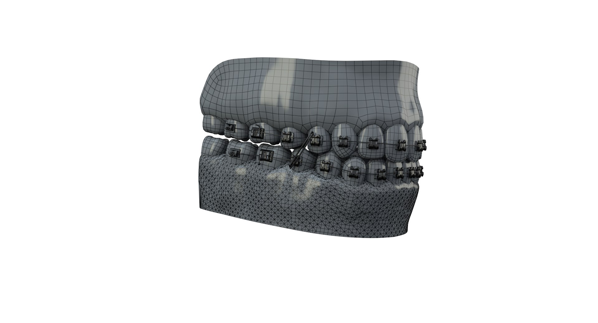 3D Model Teeth Braces - TurboSquid 1522317