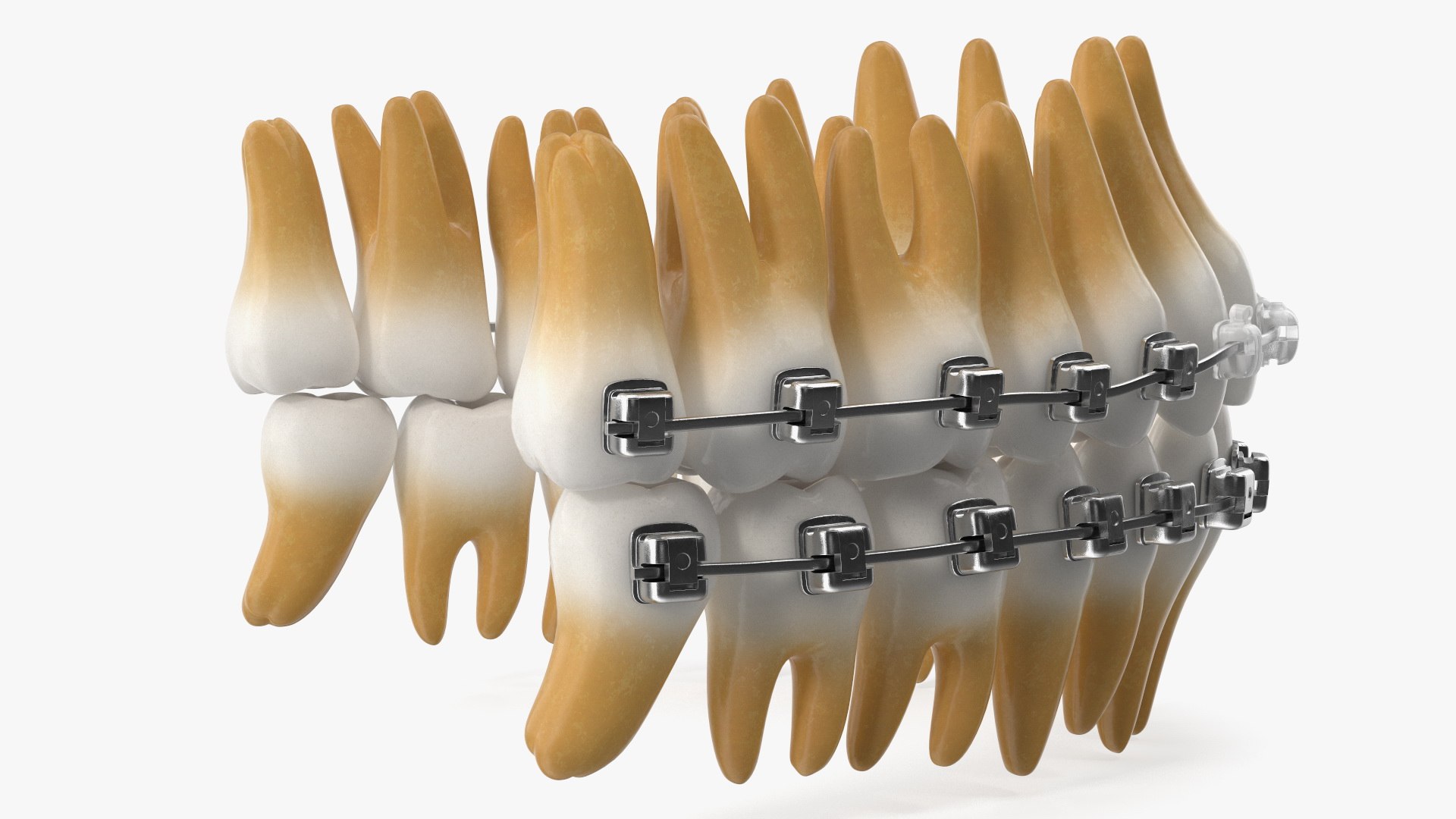 Ligature-Free Braces On Plastic Teeth 3D - TurboSquid 2335576