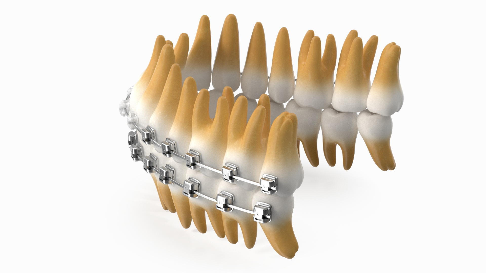 Ligature-Free Braces On Plastic Teeth 3D - TurboSquid 2335576