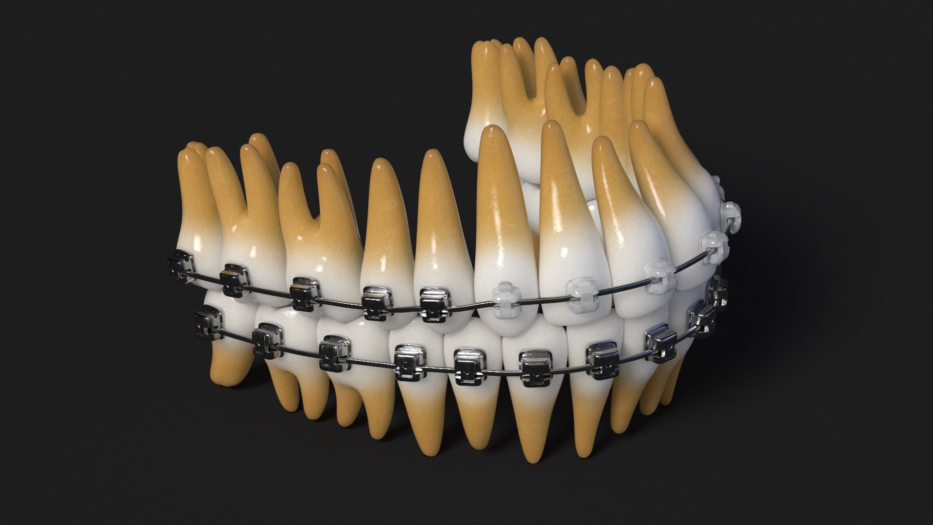 Ligature-Free Braces On Plastic Teeth 3D - TurboSquid 2335576