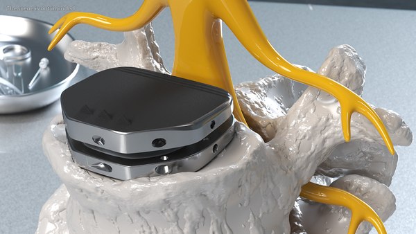 modelo 3d Implante de disco intervertebral instalado en la columna ...