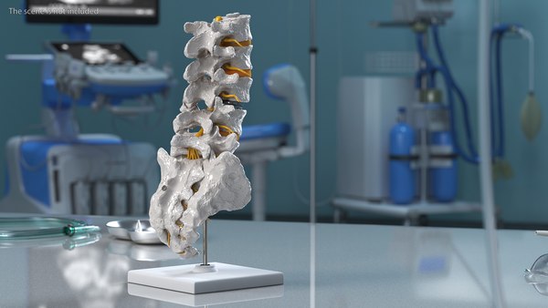 modelo 3d Implante de disco intervertebral instalado en la columna ...