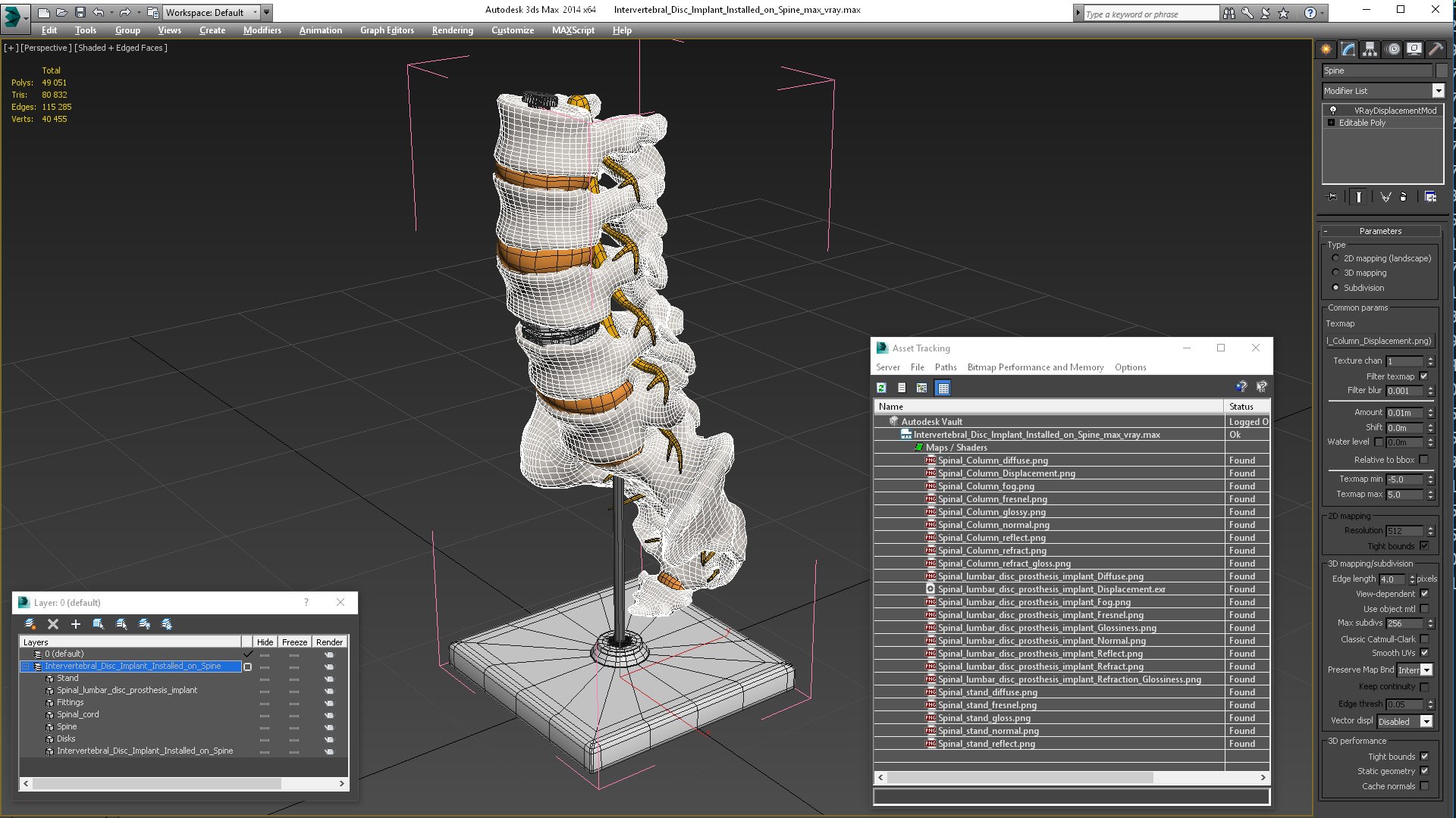 3D Intervertebral Disc Implant Installed On Spine - TurboSquid 2205533