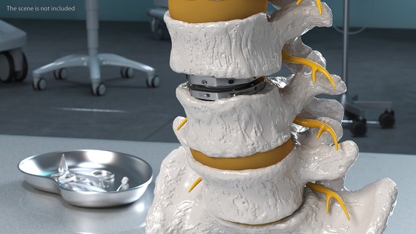 modelo 3d Implante de disco intervertebral instalado en la columna ...
