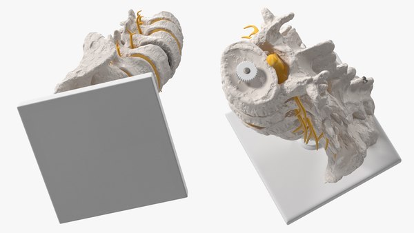 modelo 3d Implante de disco intervertebral instalado en la columna ...