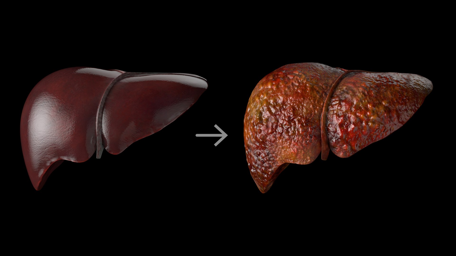 3D model Liver damaging stages animation - TurboSquid 1737157