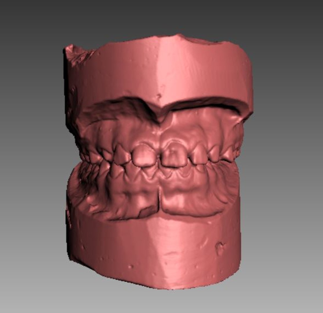 Denture Human 3D - TurboSquid 1335388