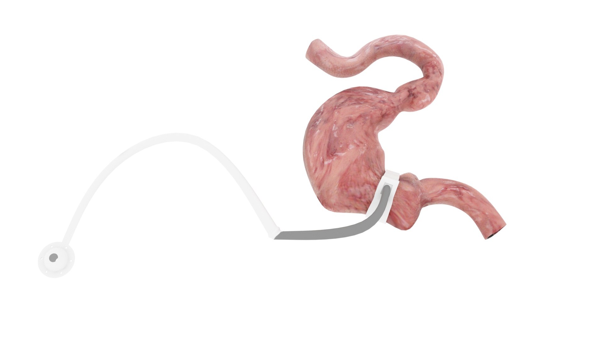3D Stomach With Stomach Band Model - TurboSquid 2282307