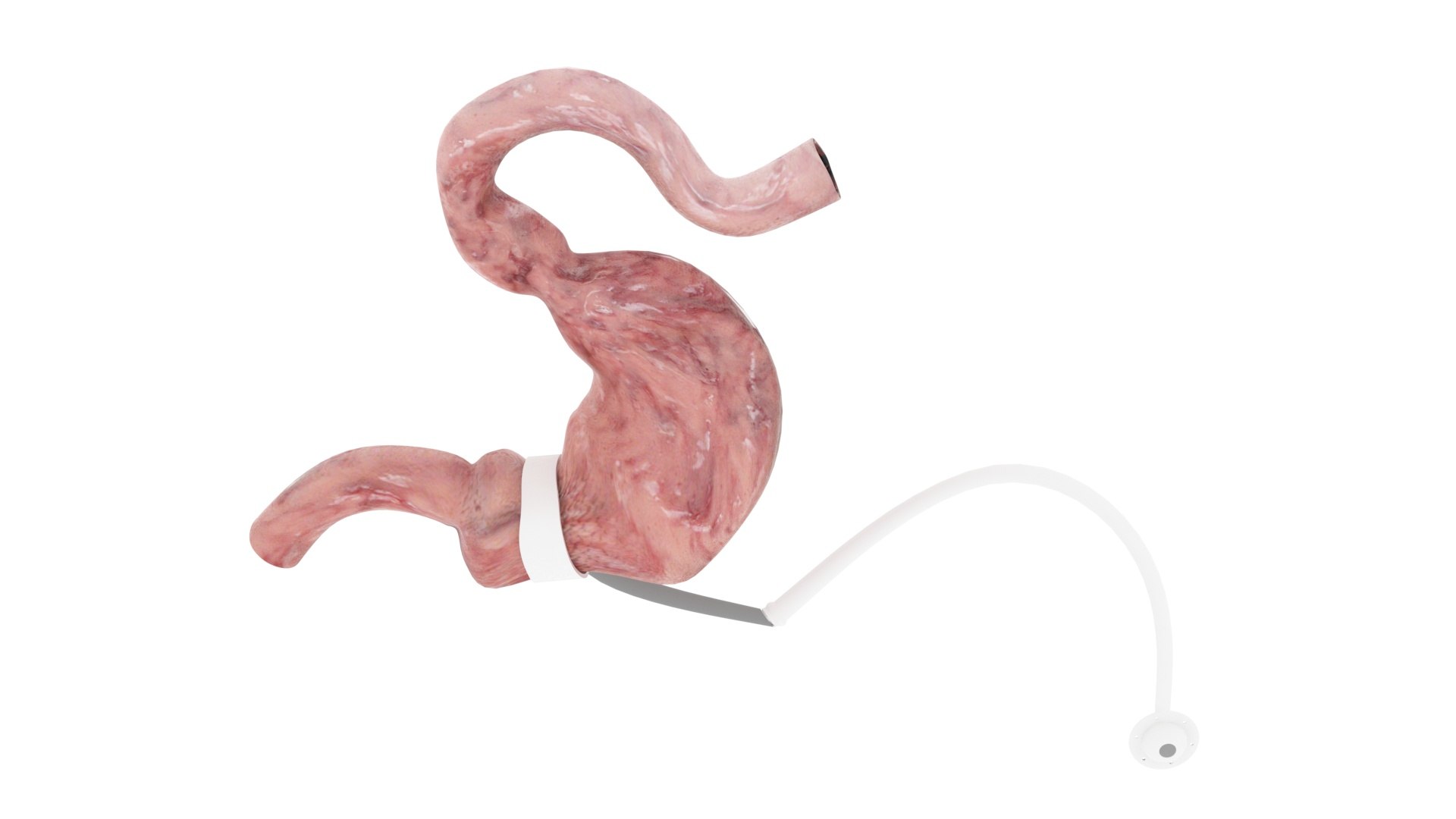 3D Stomach With Stomach Band Model - TurboSquid 2282307