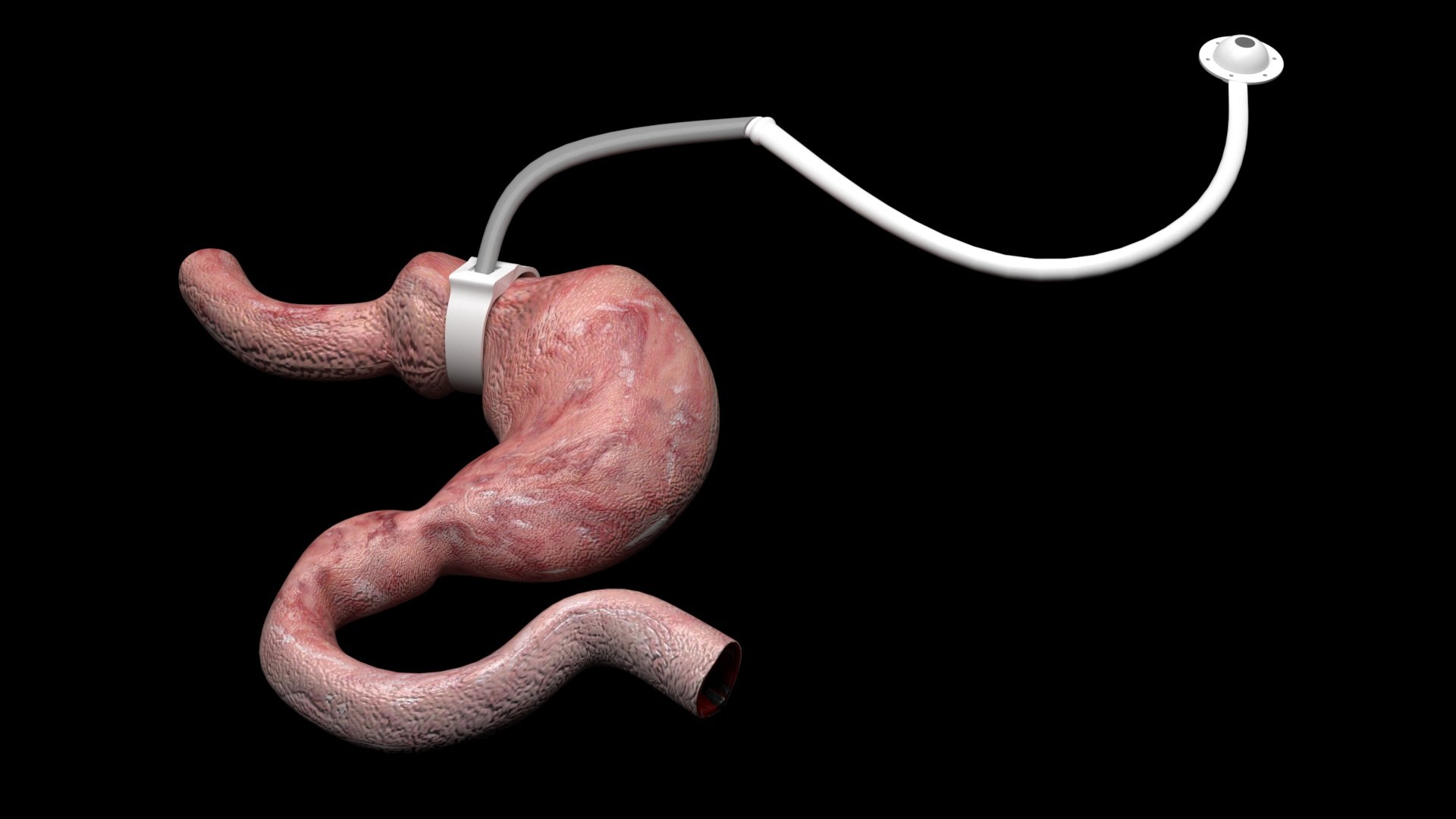 3D Stomach With Stomach Band Model - TurboSquid 2282307