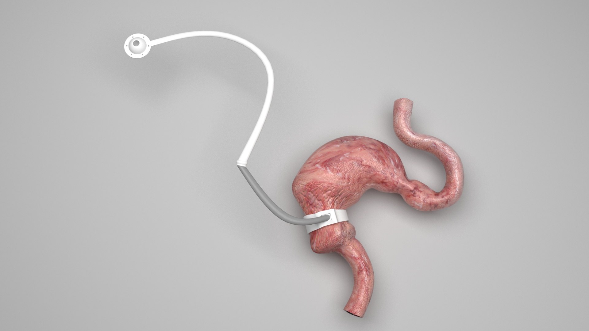 3D Stomach With Stomach Band Model - TurboSquid 2282307