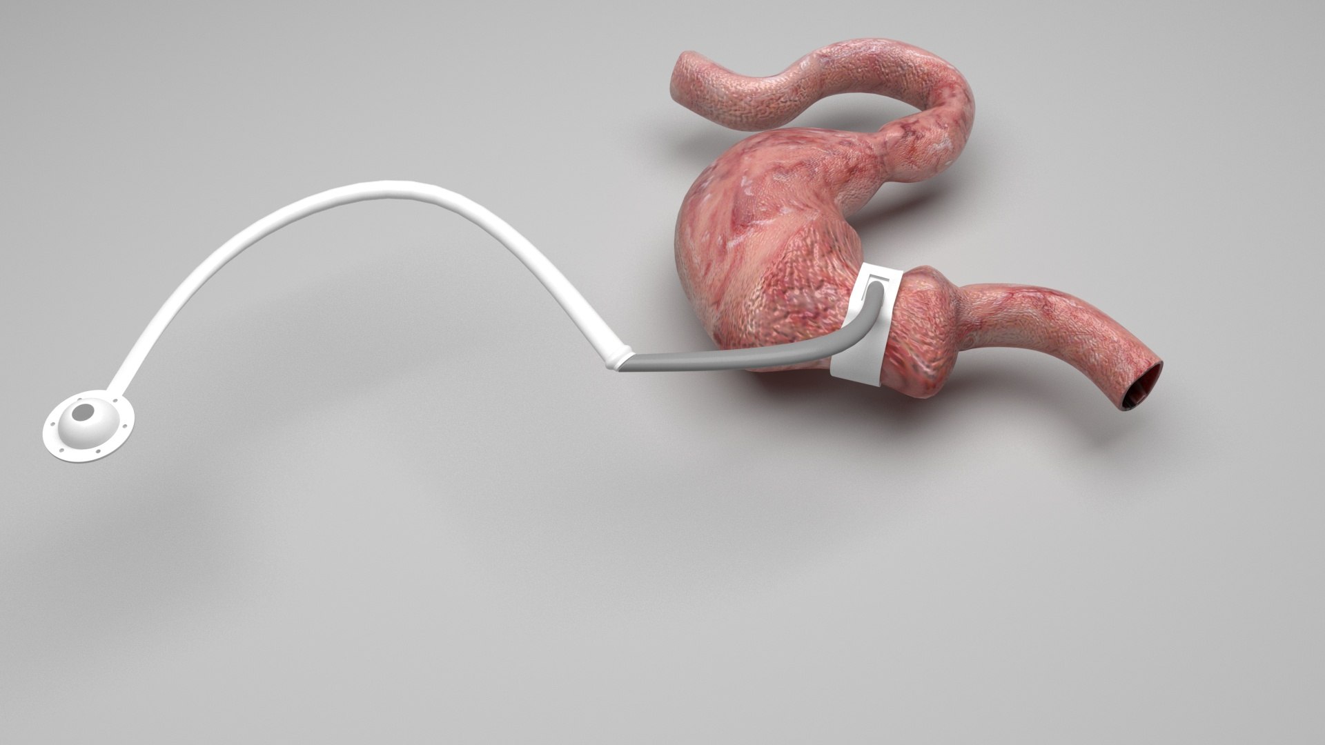 3D Stomach With Stomach Band Model - TurboSquid 2282307