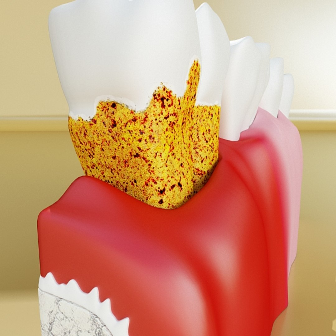 Teeth Pathologies - Tooth 3d 3ds