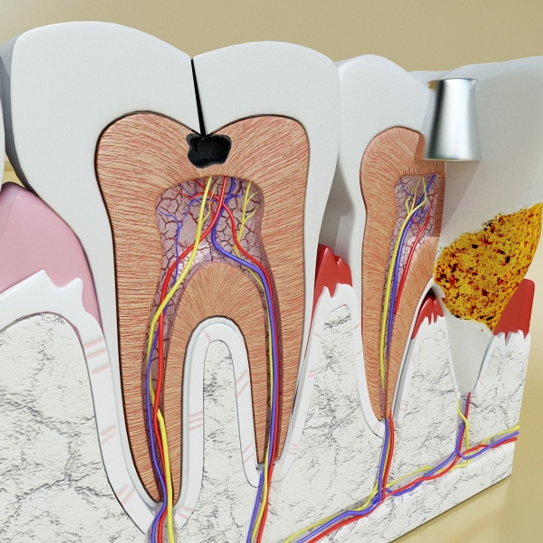 Teeth Pathologies - Tooth 3d 3ds
