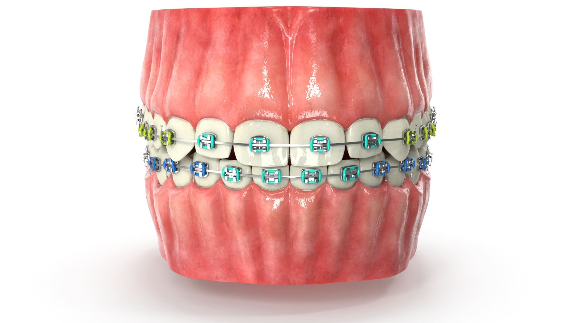 3D Model Human Mouth With Steel Dental Braces V04 - TurboSquid 2210880