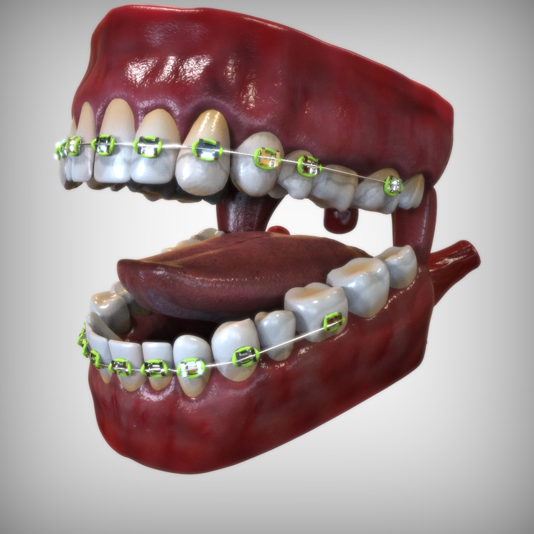 3D Human Mouth Dental Braces Model - TurboSquid 1520695