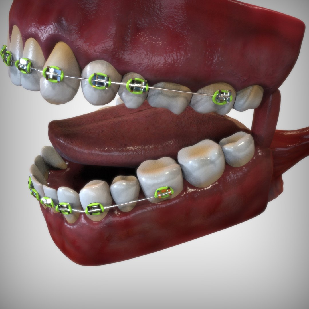 3D Human Mouth Dental Braces Model - TurboSquid 1520695