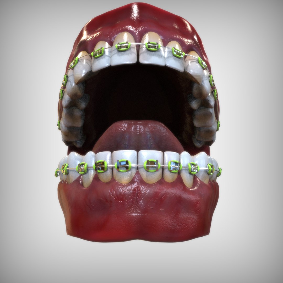 3D Human Mouth Dental Braces Model - TurboSquid 1520695