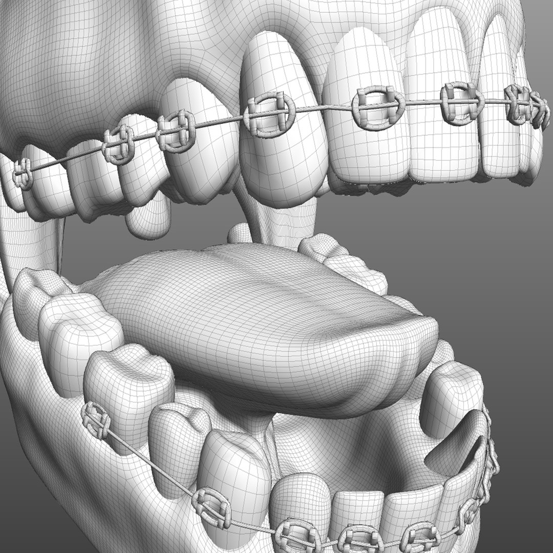 3D Human Mouth Dental Braces Model - TurboSquid 1520695