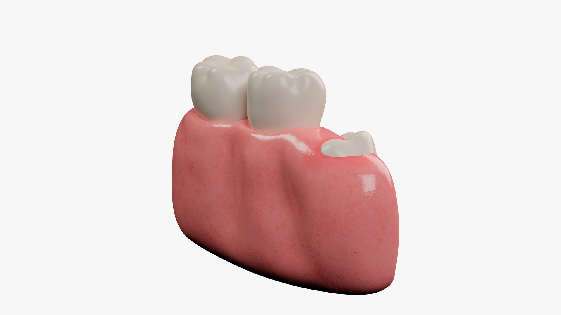 Impacted Wisdom Teeth Incision Model - TurboSquid 1866827