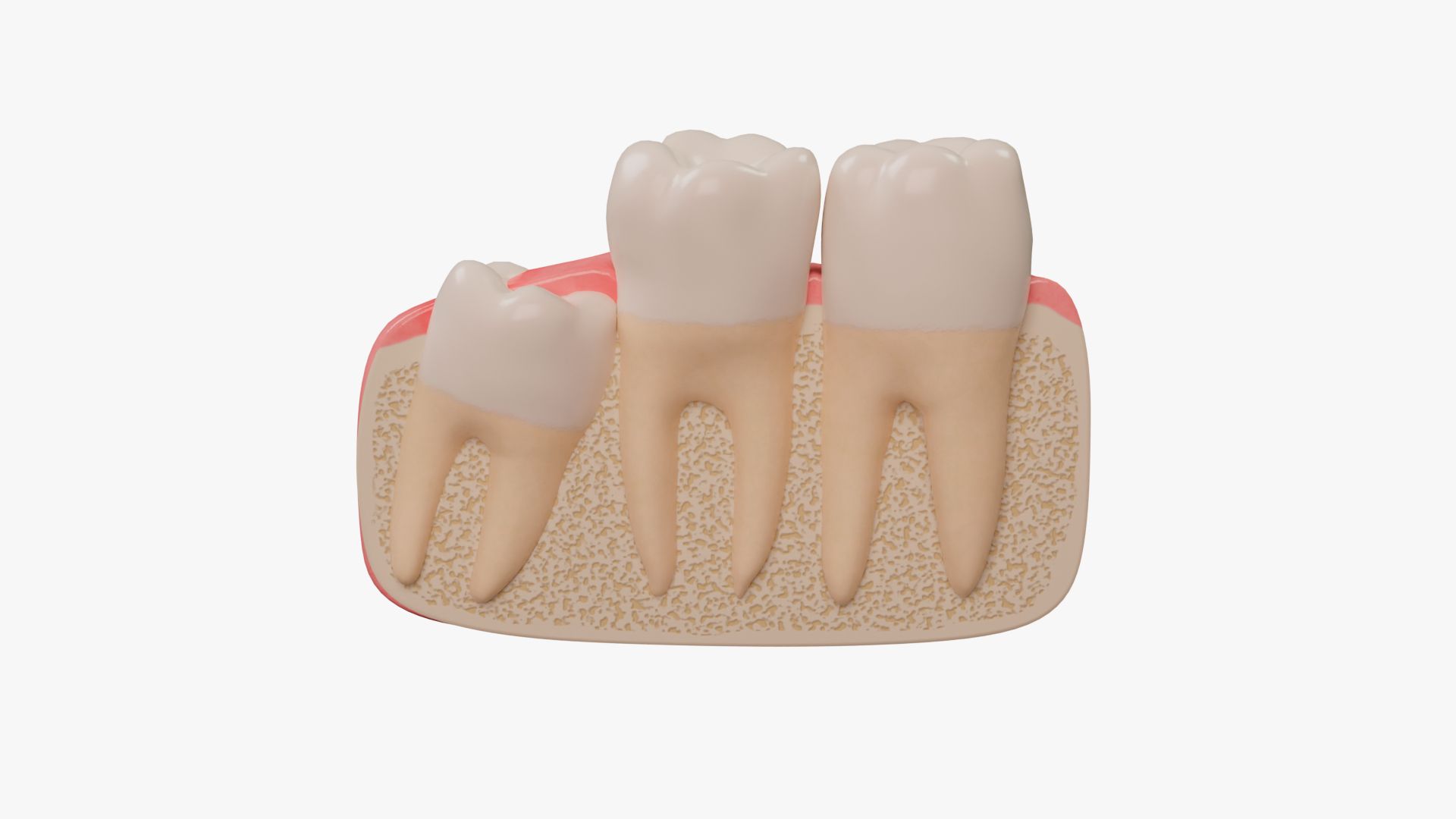 Impacted Wisdom Teeth Incision Model - TurboSquid 1866827