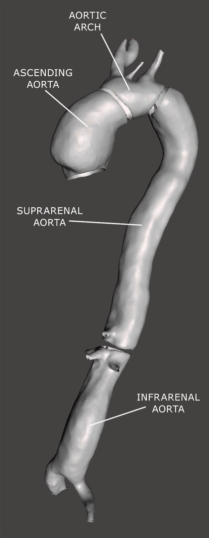 Real Aortic Dissection 3D Model - TurboSquid 2147080