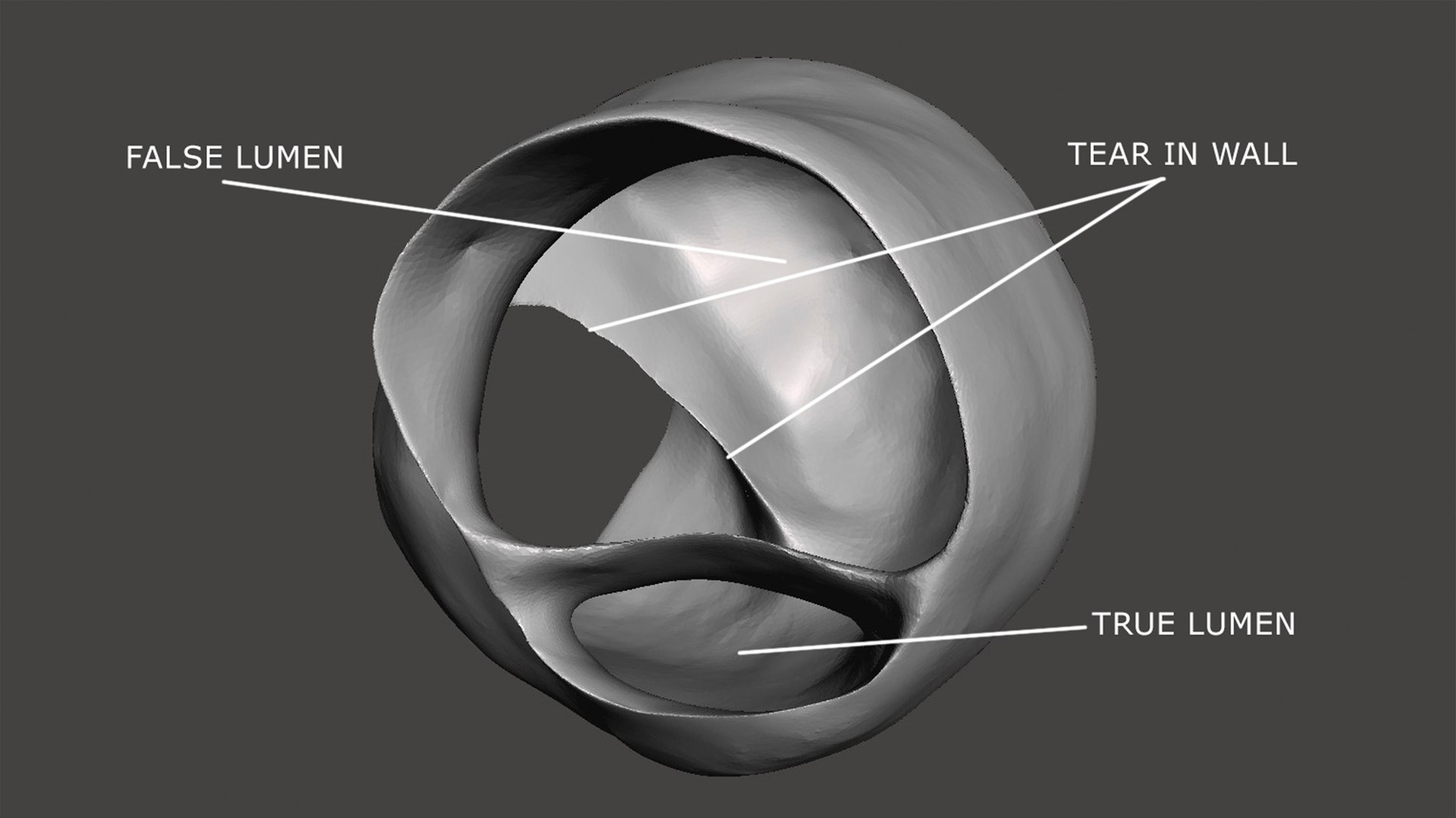 Real Aortic Dissection 3D Model - TurboSquid 2147080