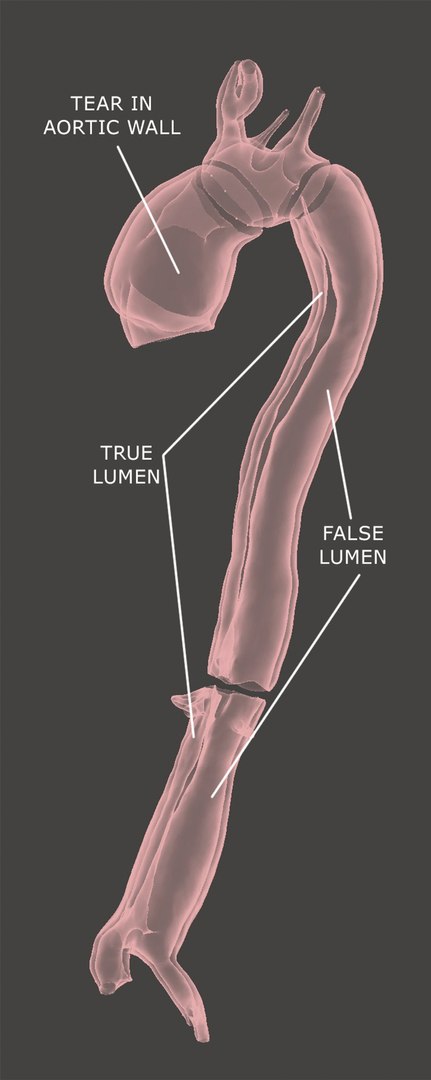 Real Aortic Dissection 3D Model - TurboSquid 2147080