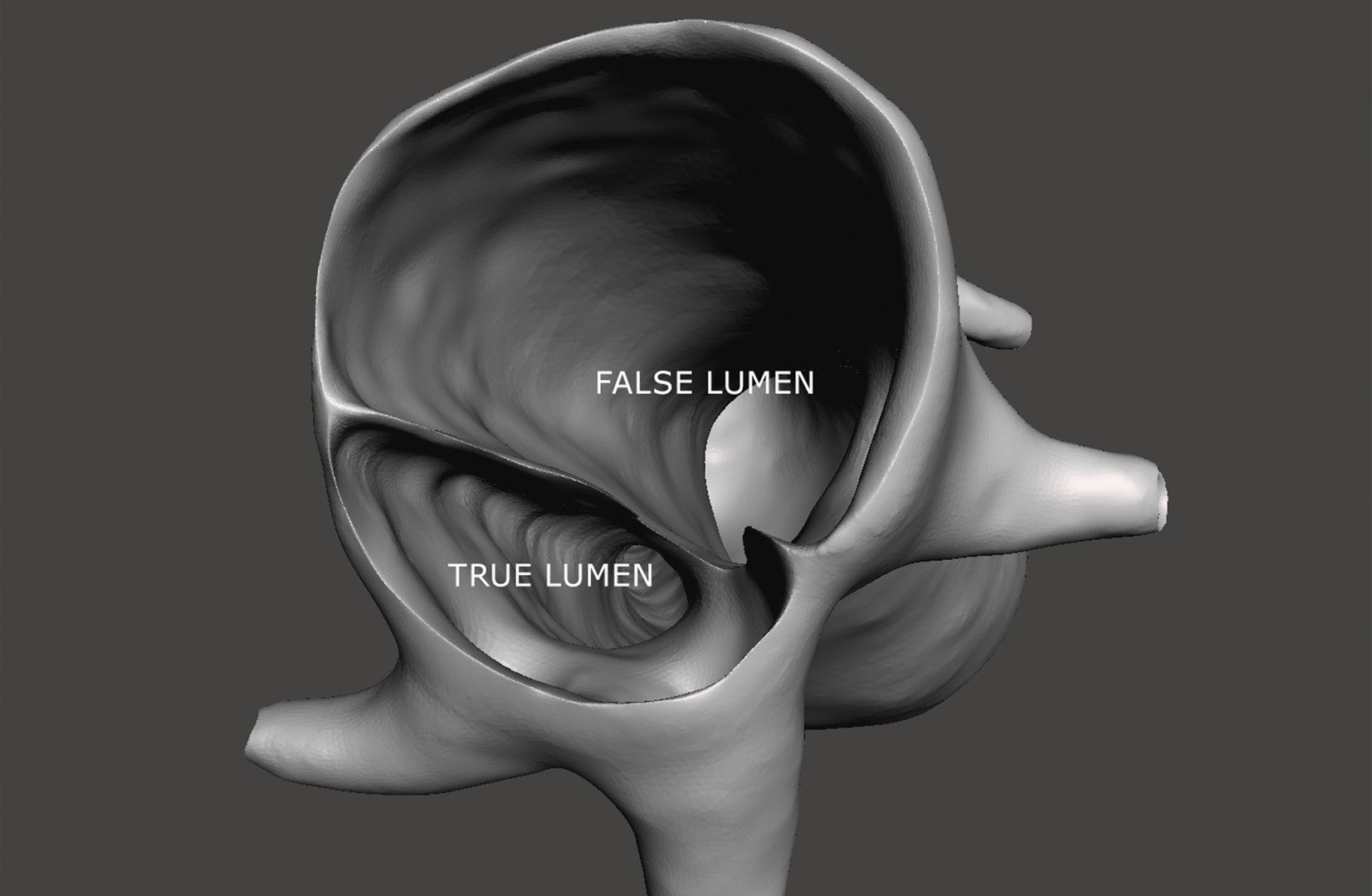 Real Aortic Dissection 3D Model - TurboSquid 2147080