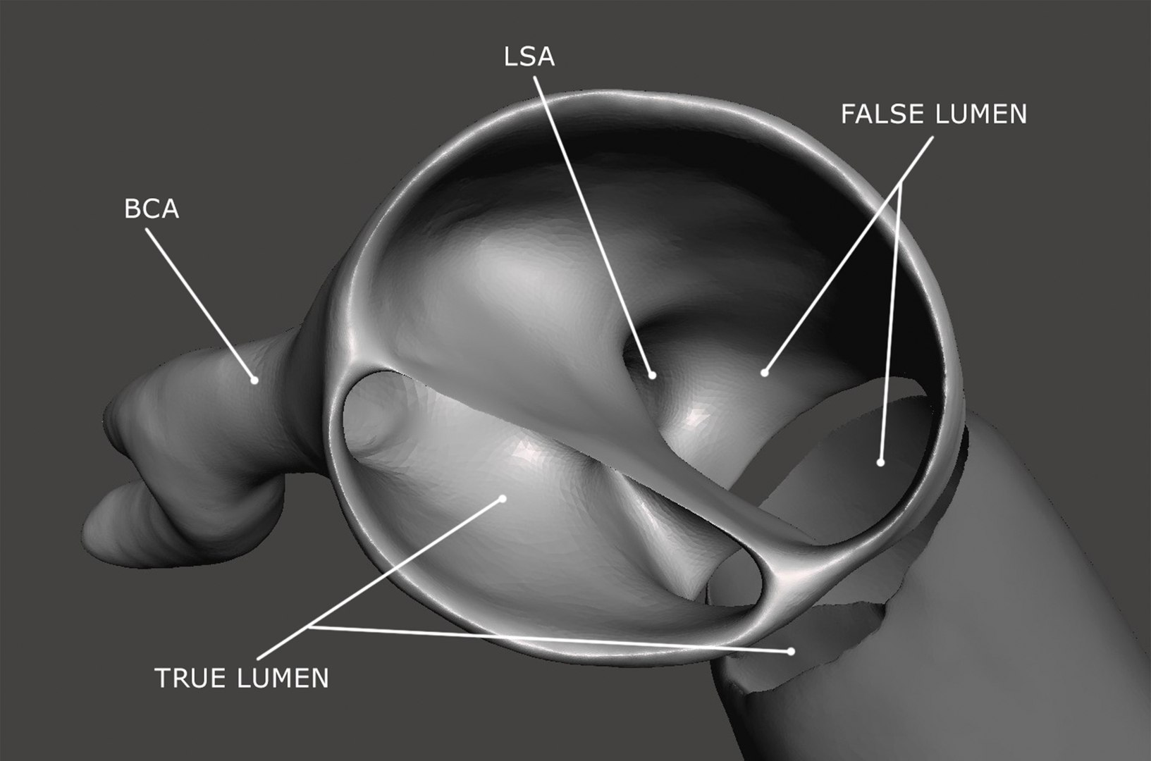 Real Aortic Dissection 3D Model - TurboSquid 2147080