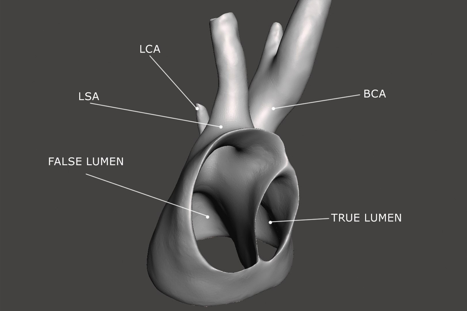 Real Aortic Dissection 3D Model - TurboSquid 2147080