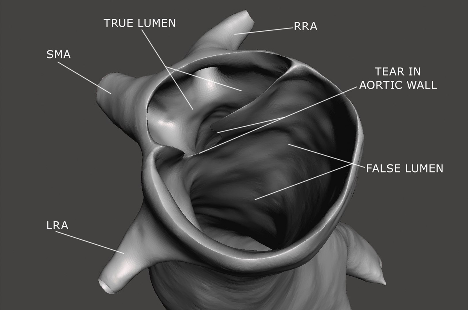Real Aortic Dissection 3d Model Turbosquid 2147080