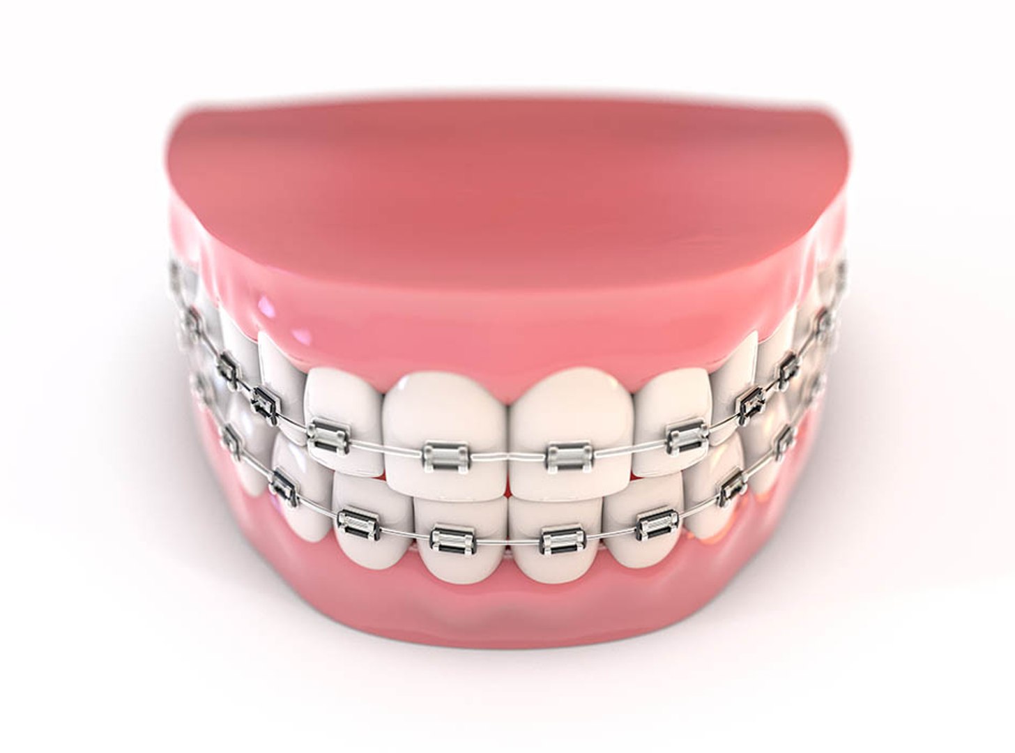 Fake Teeth Braces Model - TurboSquid 1471661