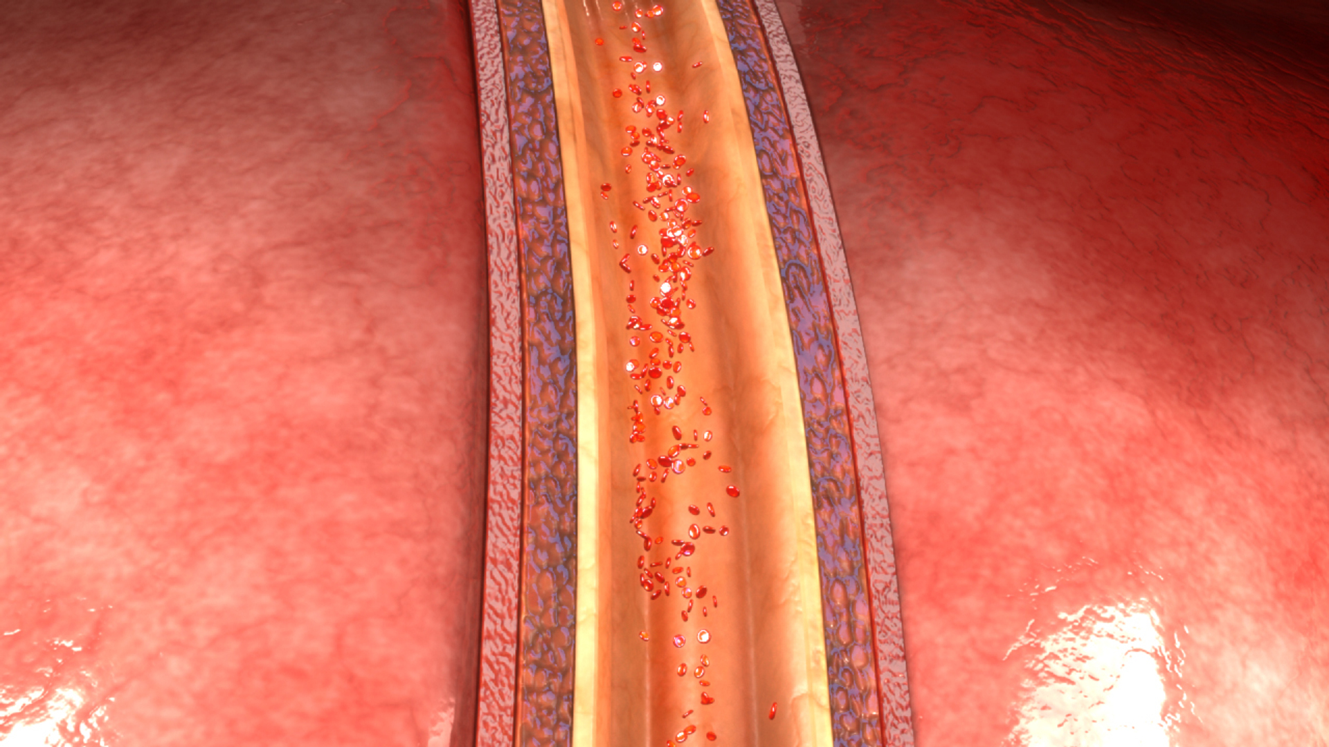 3d Artery Dissection Animation Model