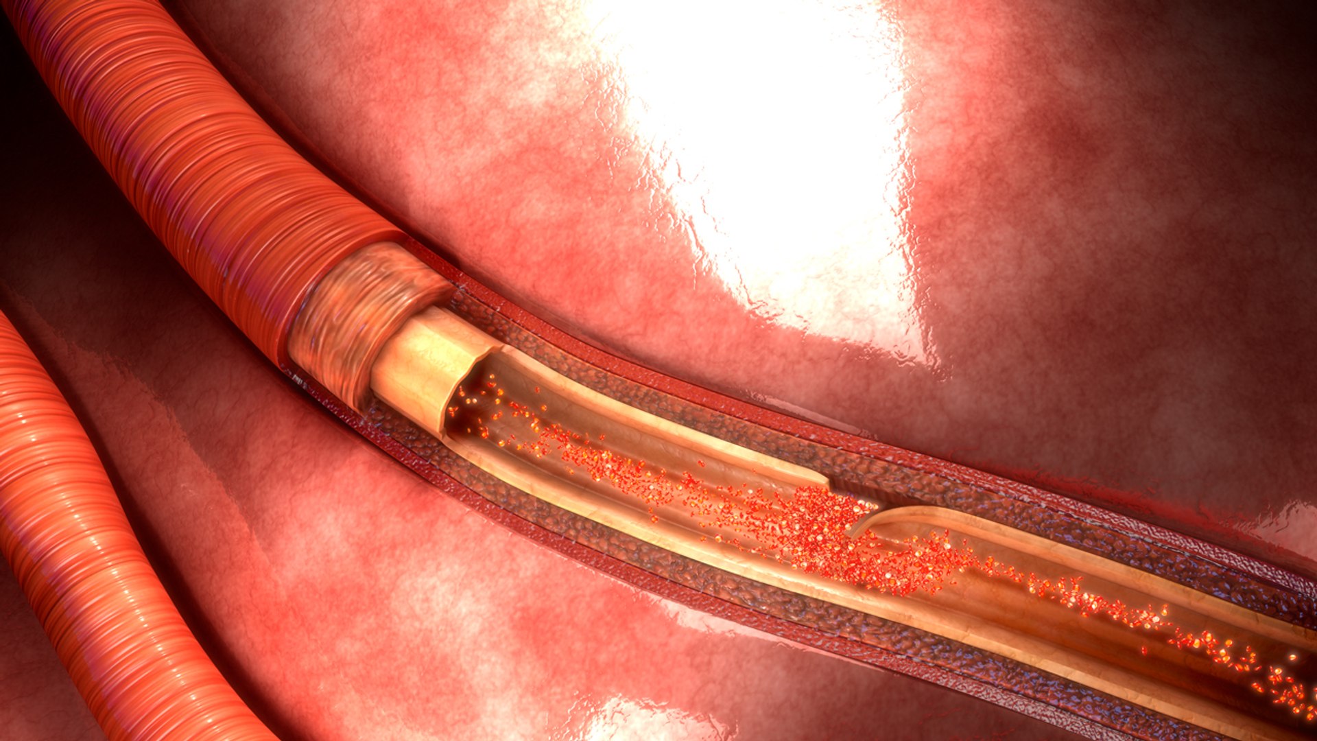 3d Artery Dissection Animation Model