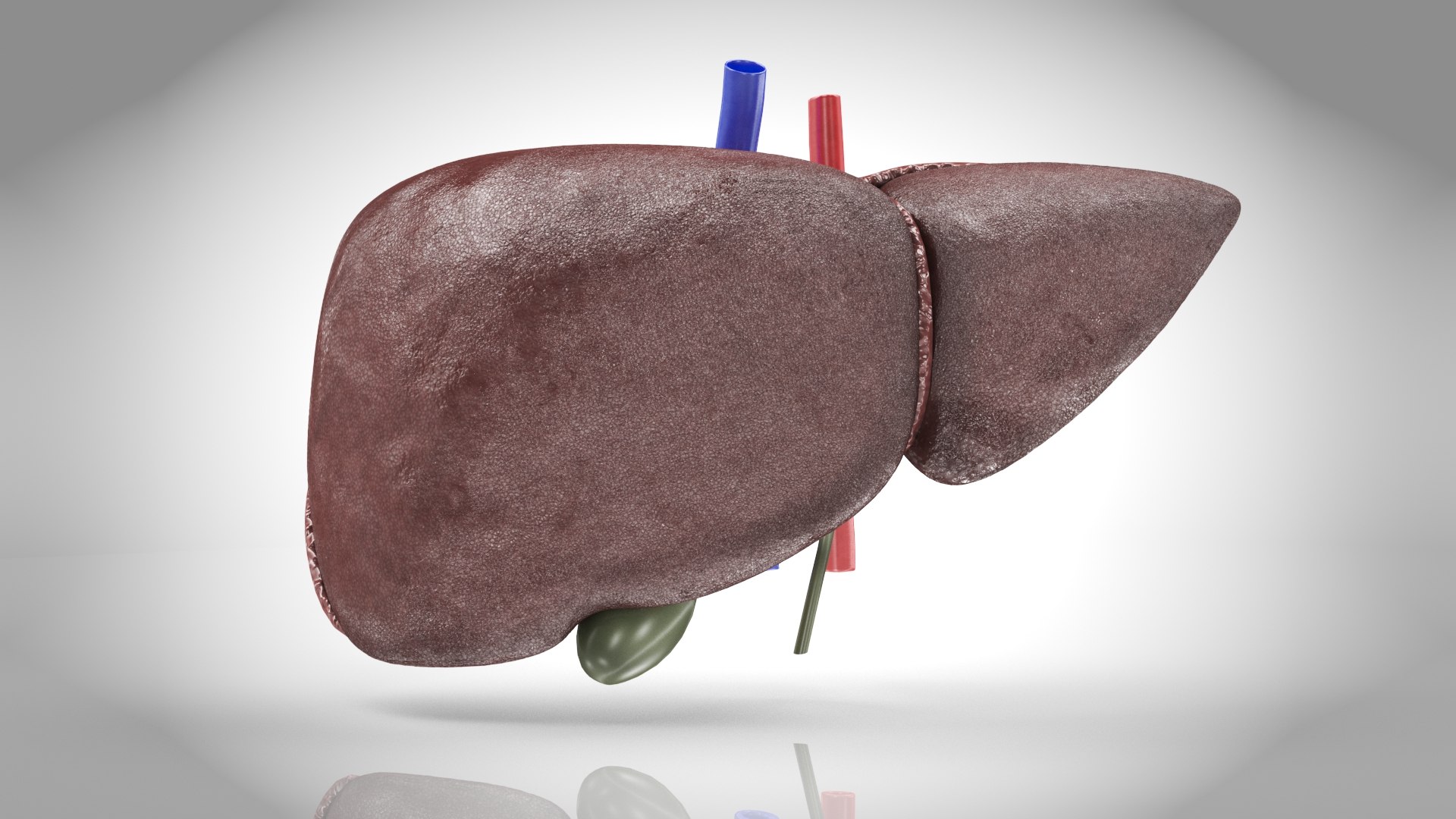 3D Fatty Liver Steatosis - TurboSquid 2132775