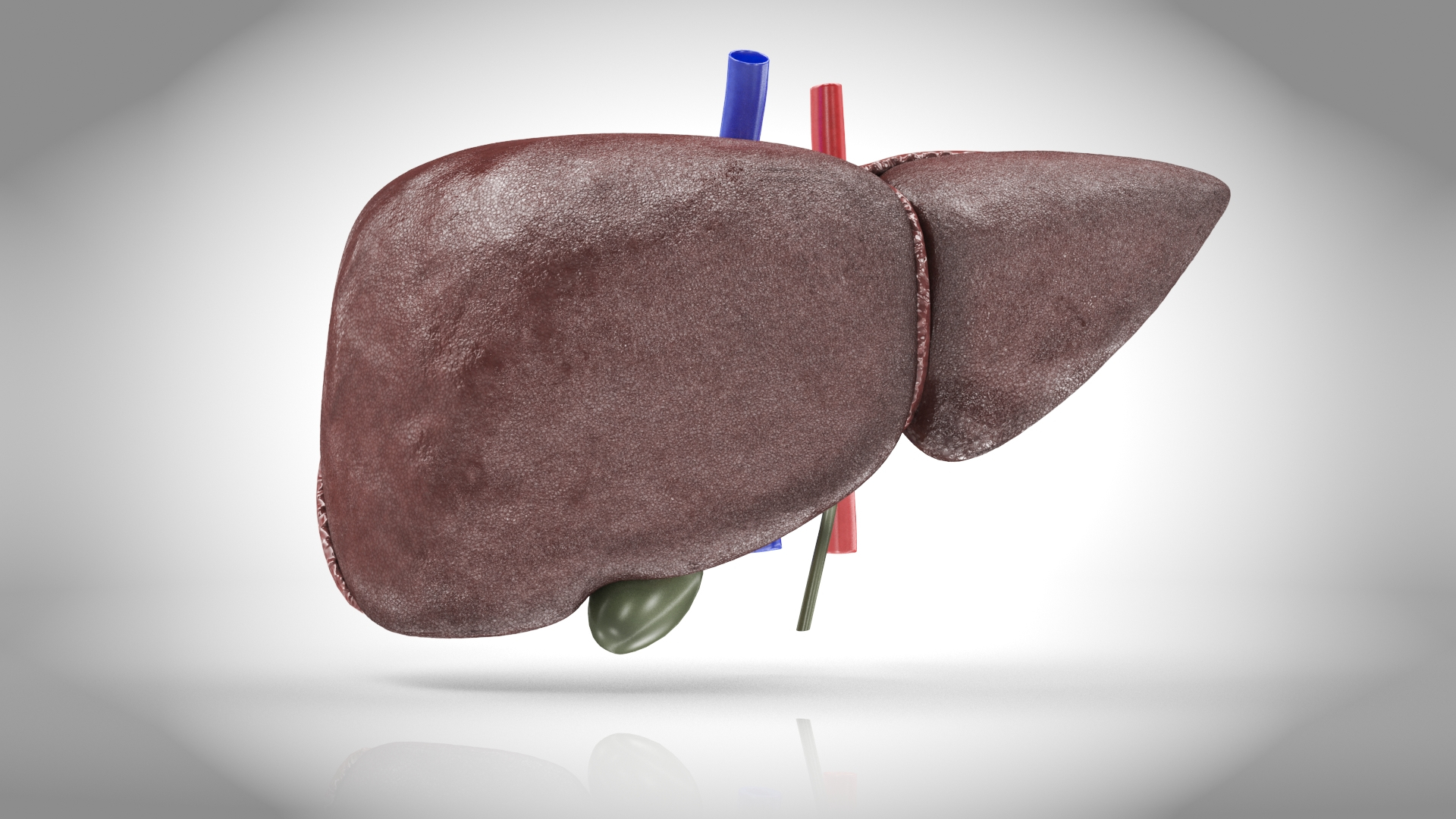 3D Fatty Liver Steatosis - TurboSquid 2132775
