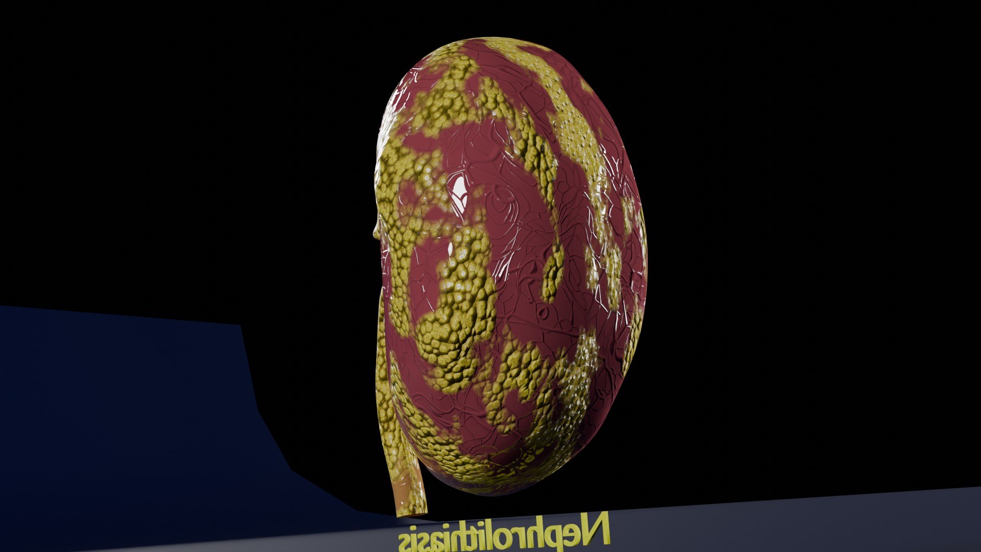 Kidney Stone Nephrolithiasis Staghorn Calculus 3D Model - TurboSquid ...