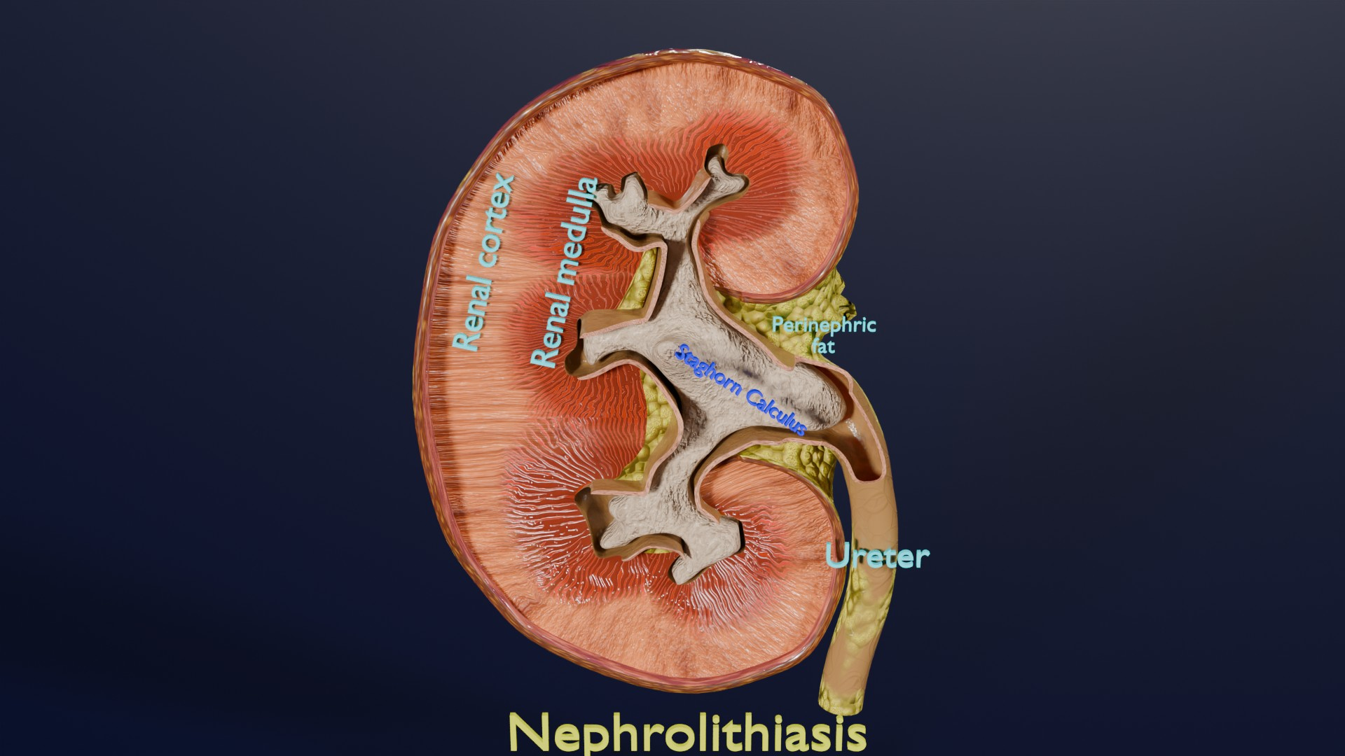 Kidney Stone Nephrolithiasis Staghorn Calculus 3D Model - TurboSquid ...