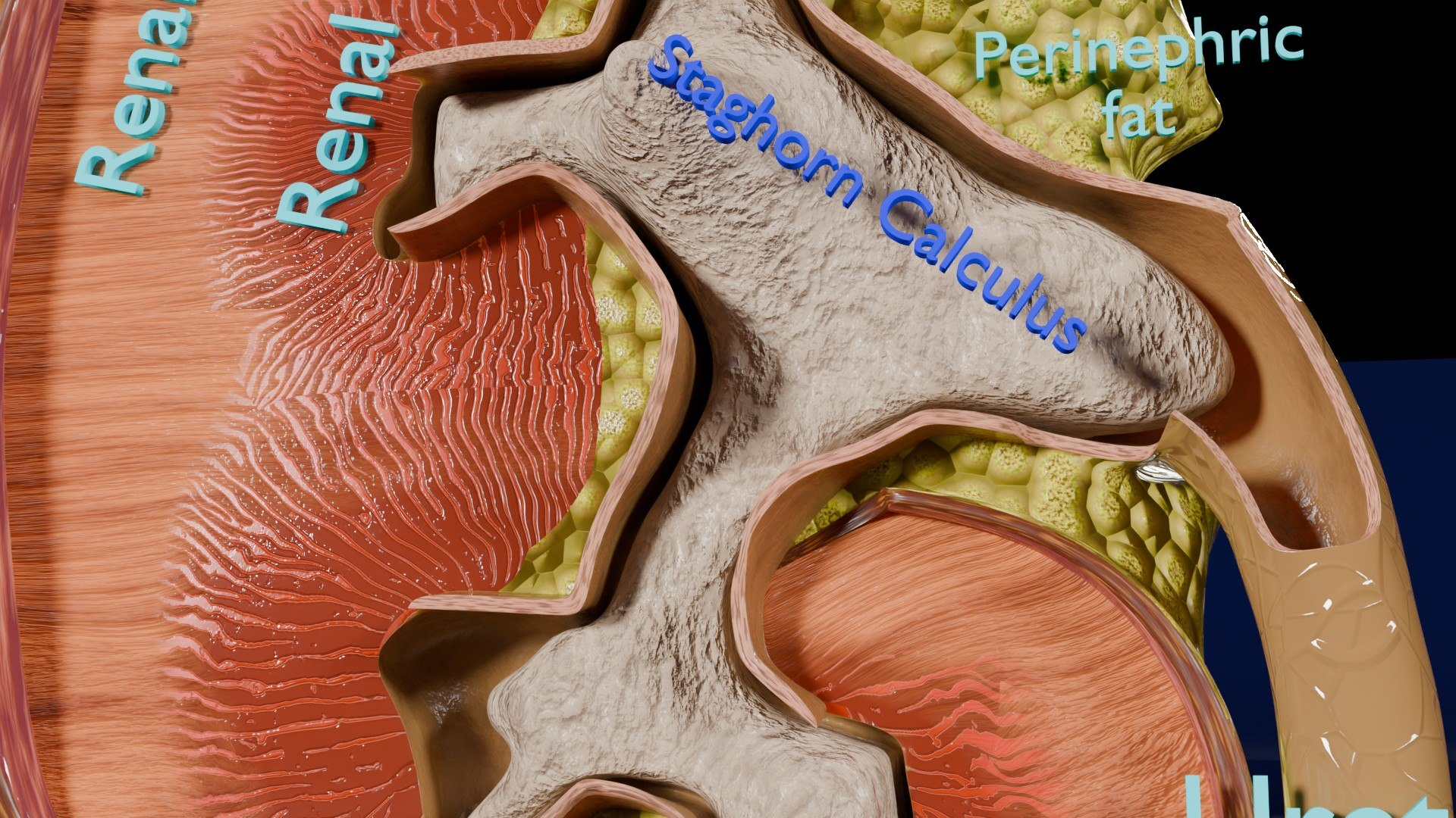 Kidney Stone Nephrolithiasis Staghorn Calculus 3D Model - TurboSquid ...