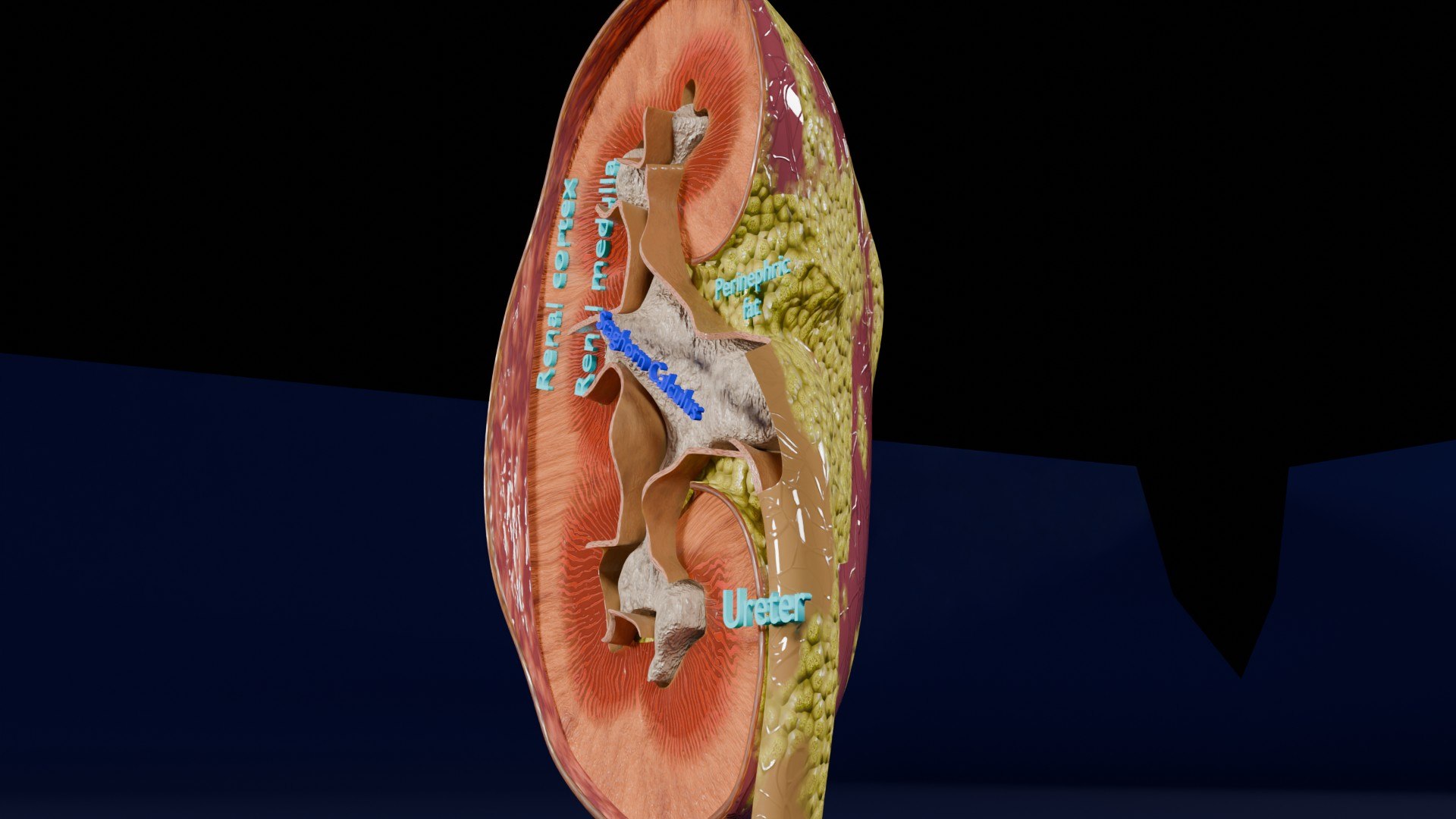 Kidney Stone Nephrolithiasis Staghorn Calculus 3D Model - TurboSquid ...
