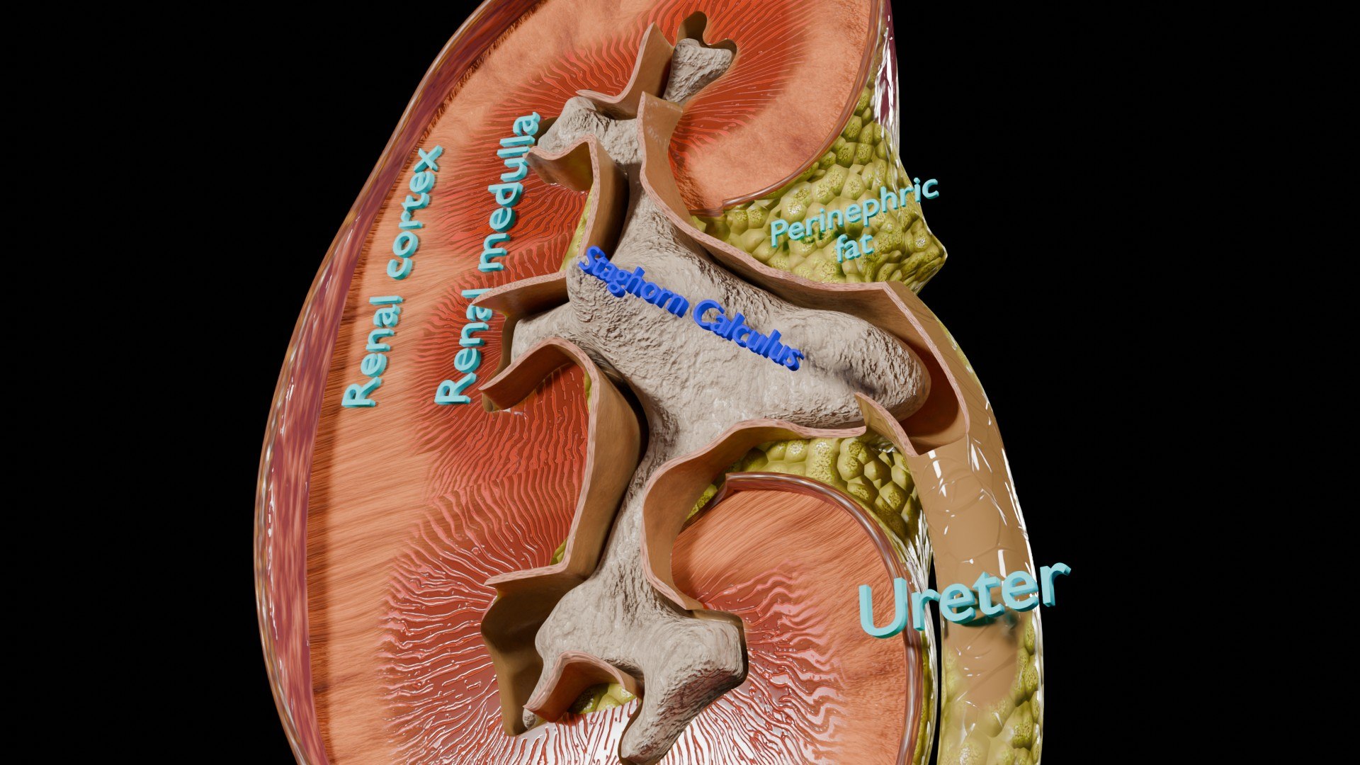 Kidney Stone Nephrolithiasis Staghorn Calculus 3D Model - TurboSquid ...