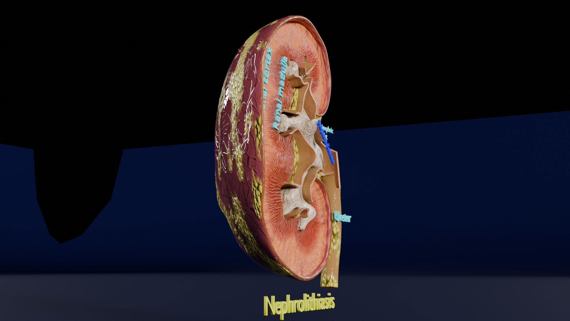 Kidney Stone Nephrolithiasis Staghorn Calculus 3D Model - TurboSquid ...