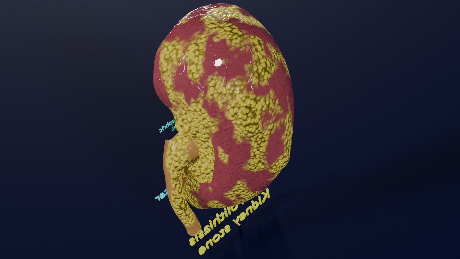 Kidney Stone Nephrolithiasis Staghorn Calculus 3D Model - TurboSquid ...