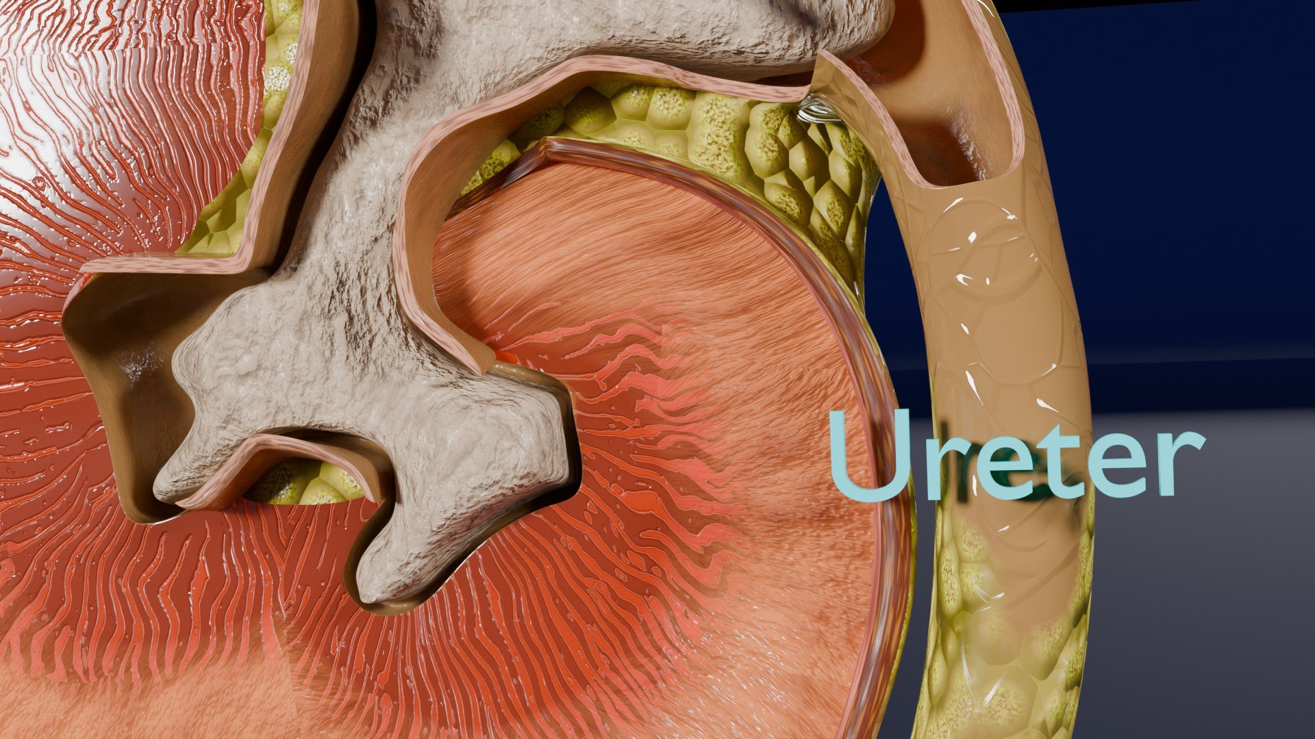Kidney Stone Nephrolithiasis Staghorn Calculus 3D Model - TurboSquid ...