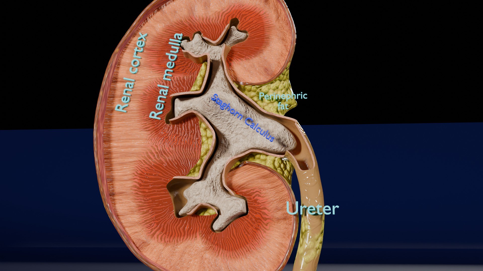 Kidney Stone Nephrolithiasis Staghorn Calculus 3D Model - TurboSquid ...