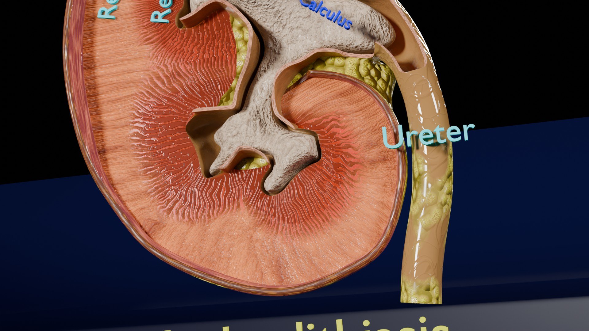 Kidney Stone Nephrolithiasis Staghorn Calculus 3D Model - TurboSquid ...